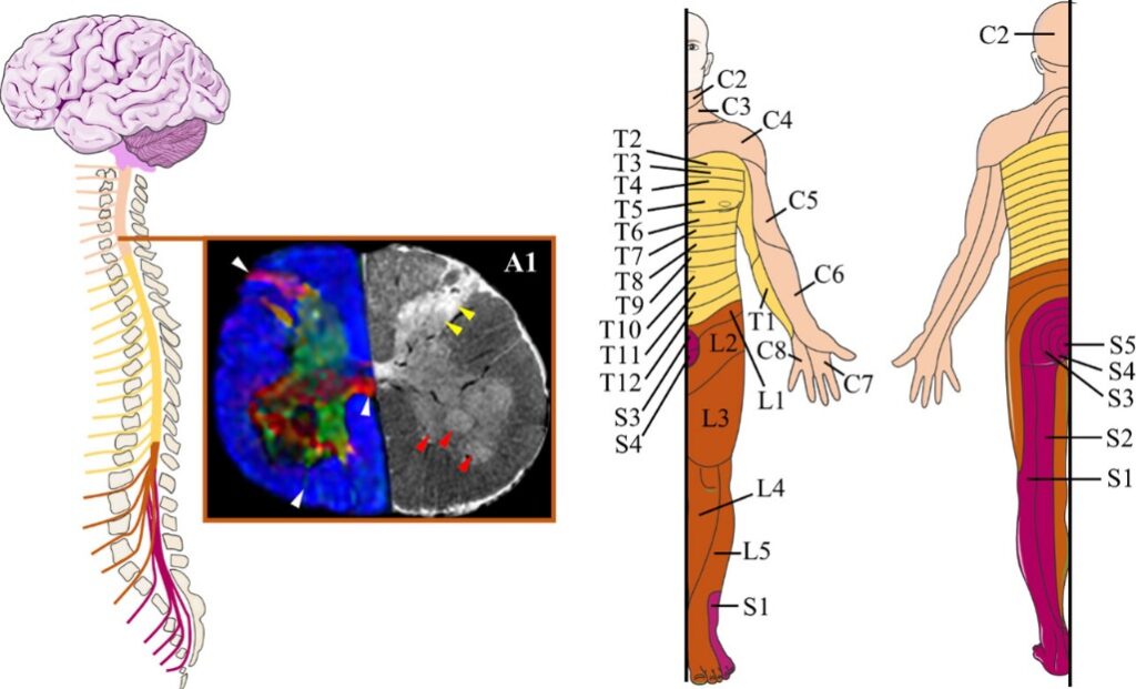 Printable Cervical Dermatome Map - Printable JD